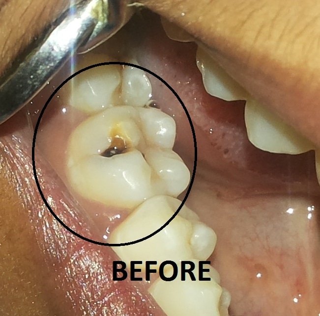 Conservative Dentistry - Dr. Ahuja's Dental & Implant Clinic