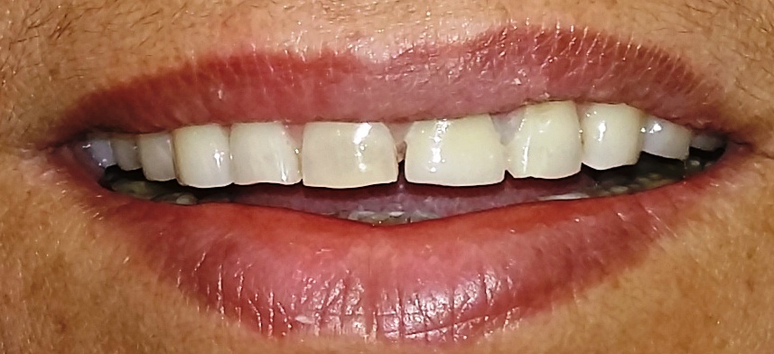 Crown And Bridge - Dr. Ahuja's Dental & Implant Clinic